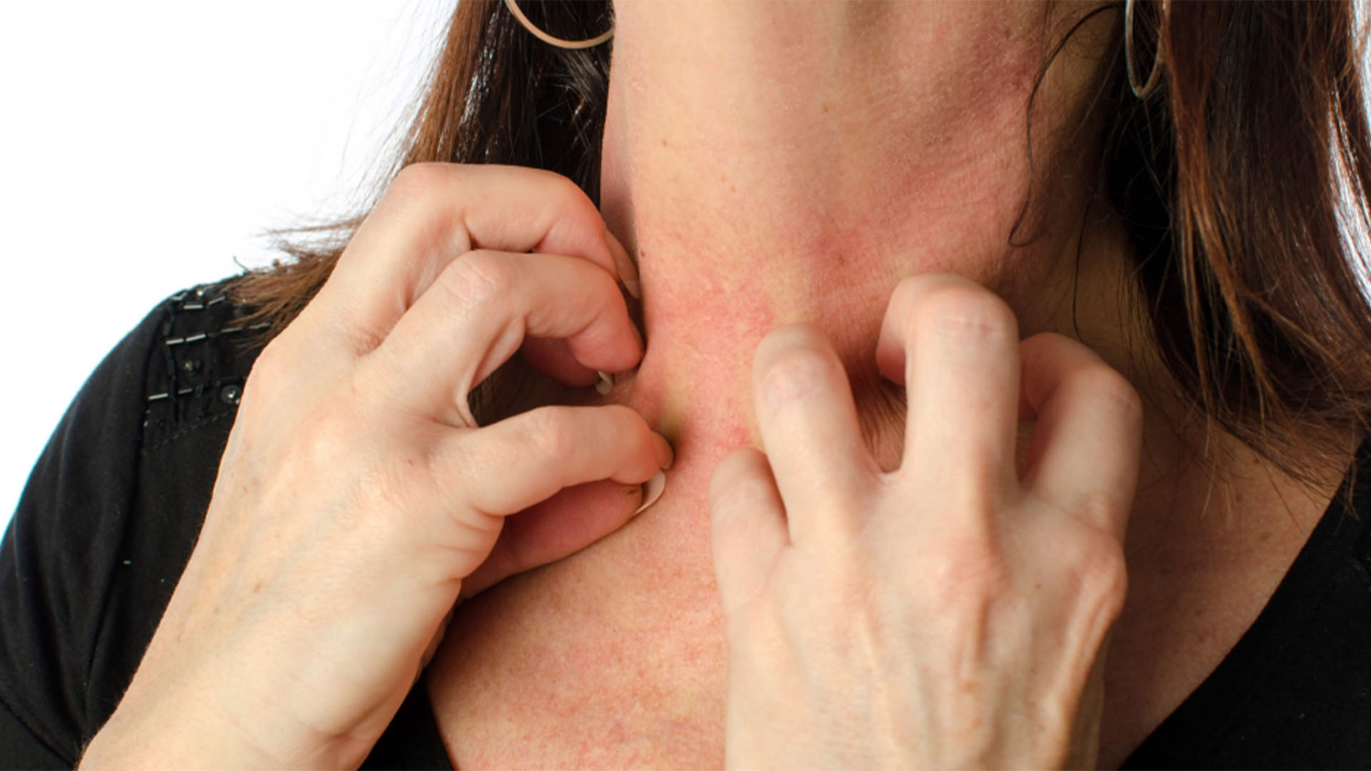 Afecta mal diagnóstico al tratamiento de alergias - Vida Universitaria ...